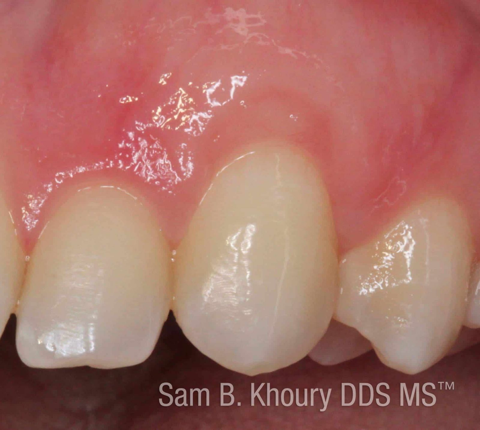 Gum Grafts Before And After - New Dental Implant Smile